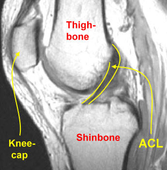 Anterior Cruciate Ligament Reconstruction | Orlin Cohen