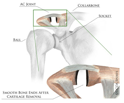 AC Joint Arthritis | Orlin & Cohen Orthopedic Group